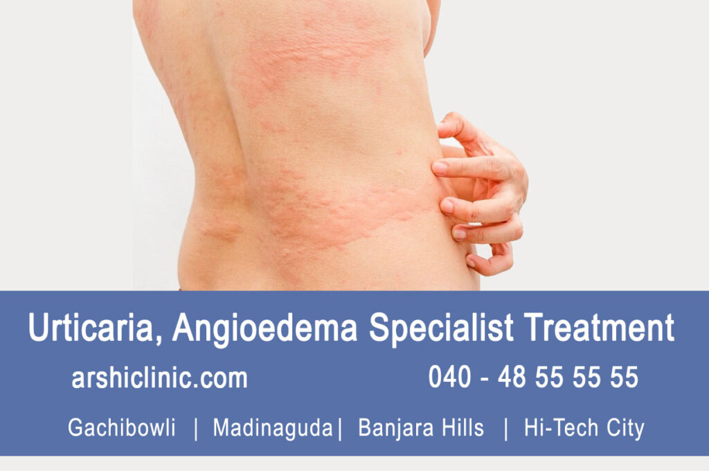 Urticaria, Angioedema Specialist Treatment in Hyderabad - Arshi Clinic